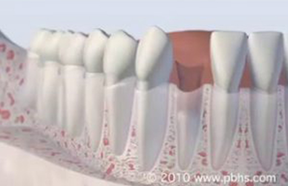Socket Preservation - Advanced Periodontics