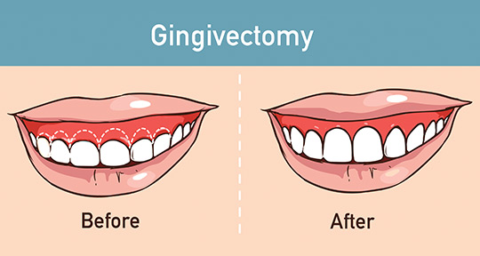 Gingivectomy - Advanced Periodontics